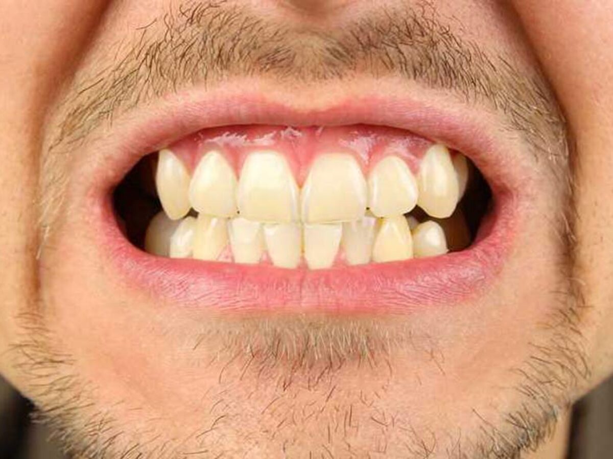 Gritting Teeth Smile