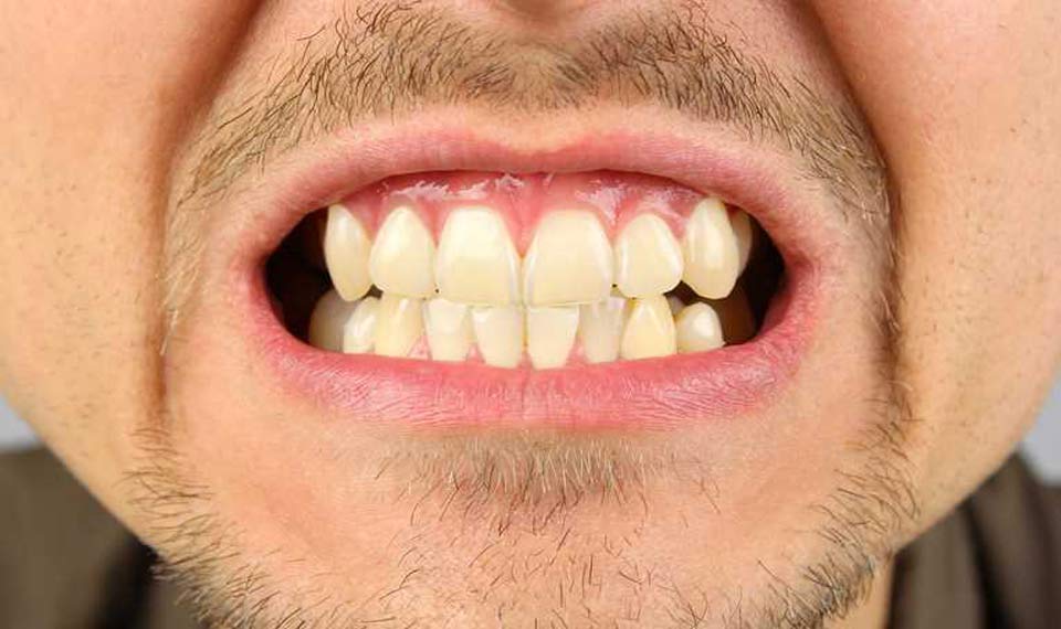 Teeth Clenching or Teeth Grinding - Smile Perfectors