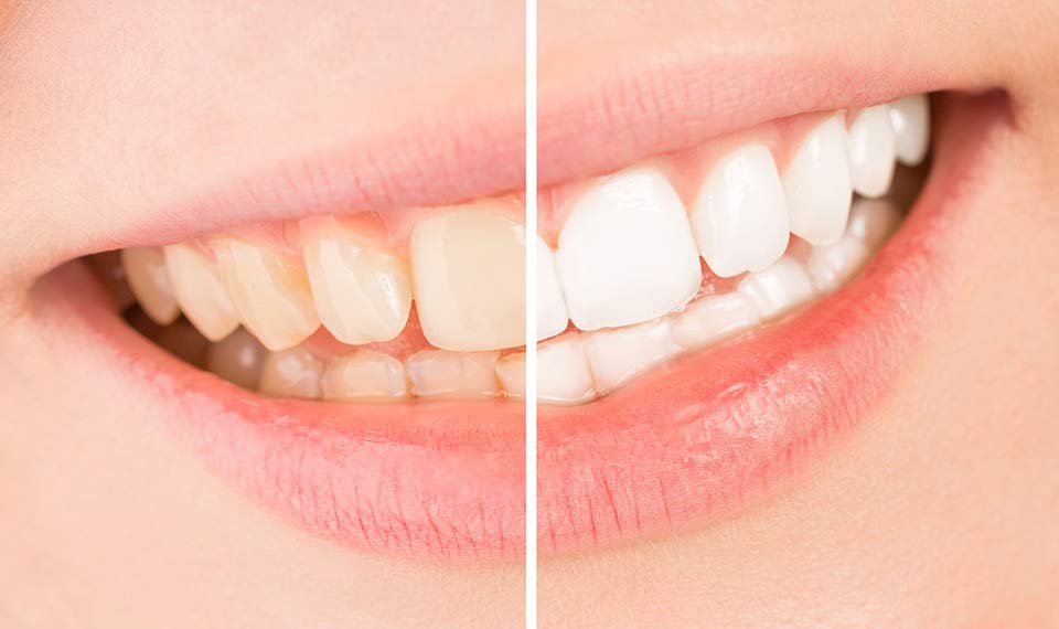 Are Your Teeth Discolored or Yellowish? Here Are the Villainism Reasons ...