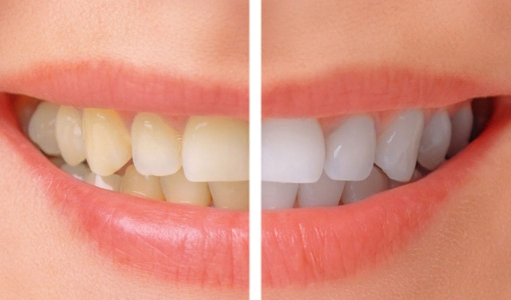 Two Great Options for Teeth Whitening - Smile Perfectors