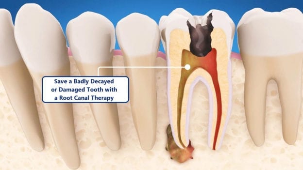 Save a Badly Decayed or Damaged Tooth with a Root Canal Therapy - Smile ...