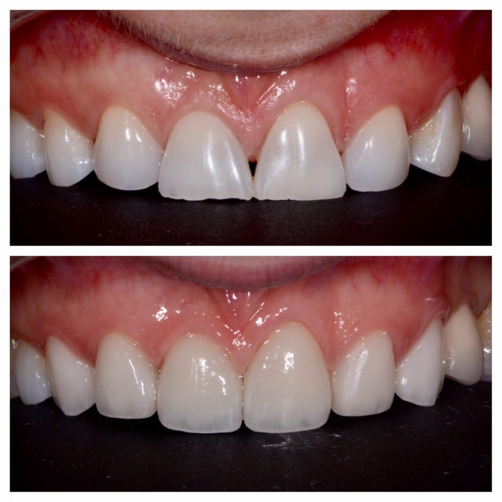 Tooth Decay: How Can You Avoid / Reverse It? - Smile Perfectors