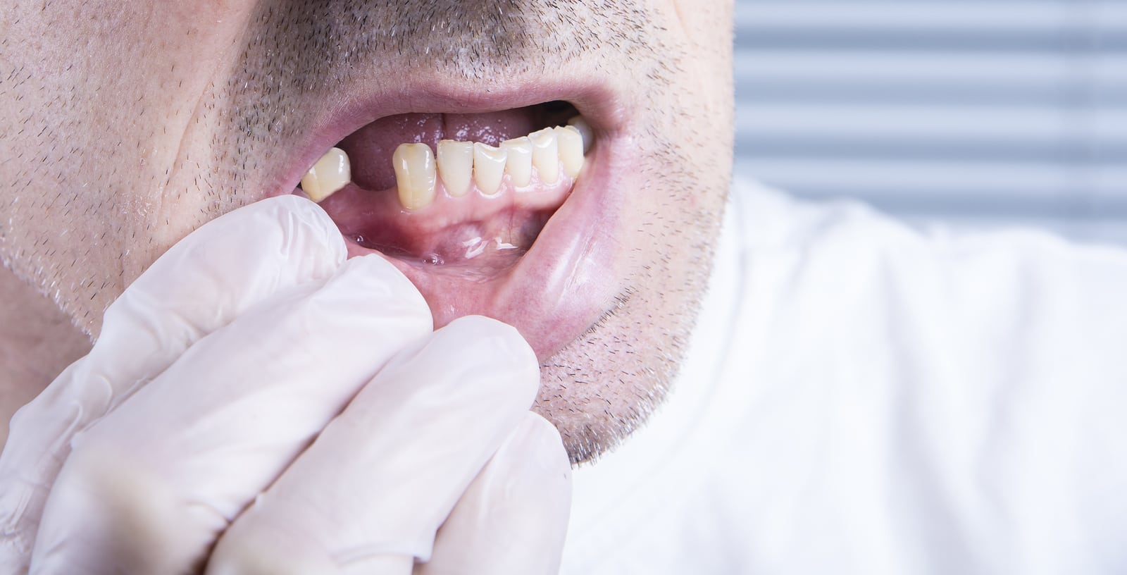 Are You Missing a Tooth or Teeth? Here are The Treatment Options You ...