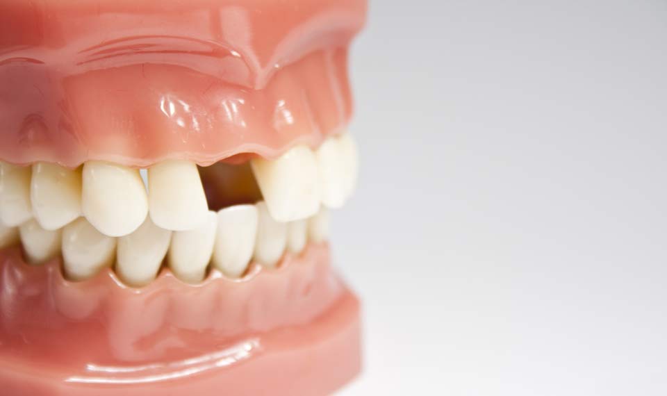 Are You Missing a Tooth or Teeth? Here are The Treatment Options You ...