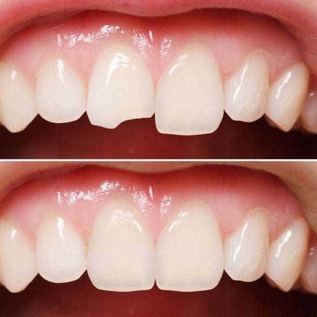 Here’s How You Can Fix Your Chipped Tooth with Cosmetic Dentistry at ...