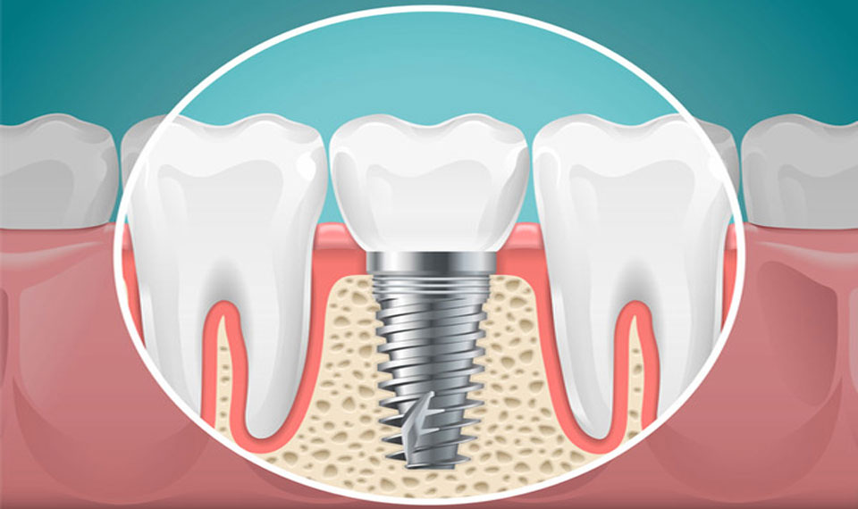 Points to Remember After Getting Dental Implants - Smile Perfectors